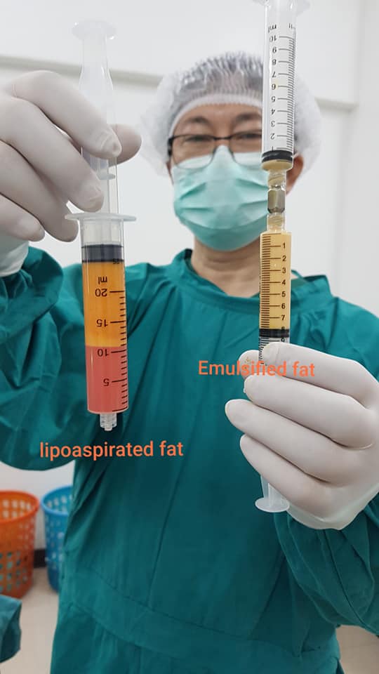 Fat Transfer to Breast – Pro Yellow Laser 1990 บาท